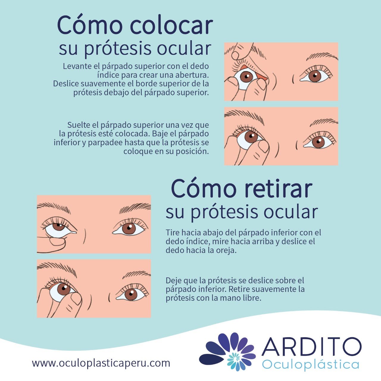 Cómo colocar y cómo retirar una prótesis ocular – Rehabilitación ...
